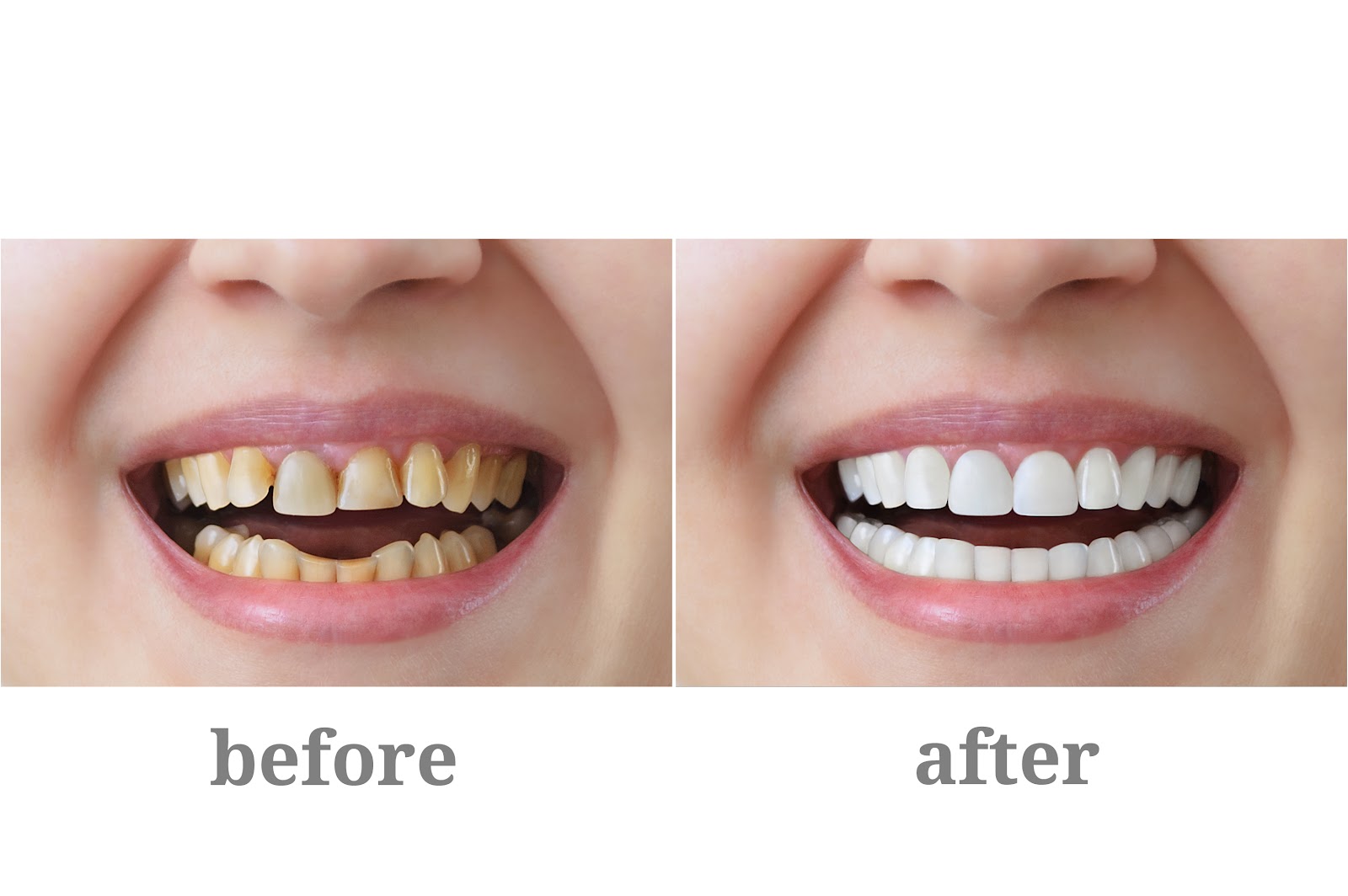 Porcelain Crowns: Simple Solutions for Perfect Teeth